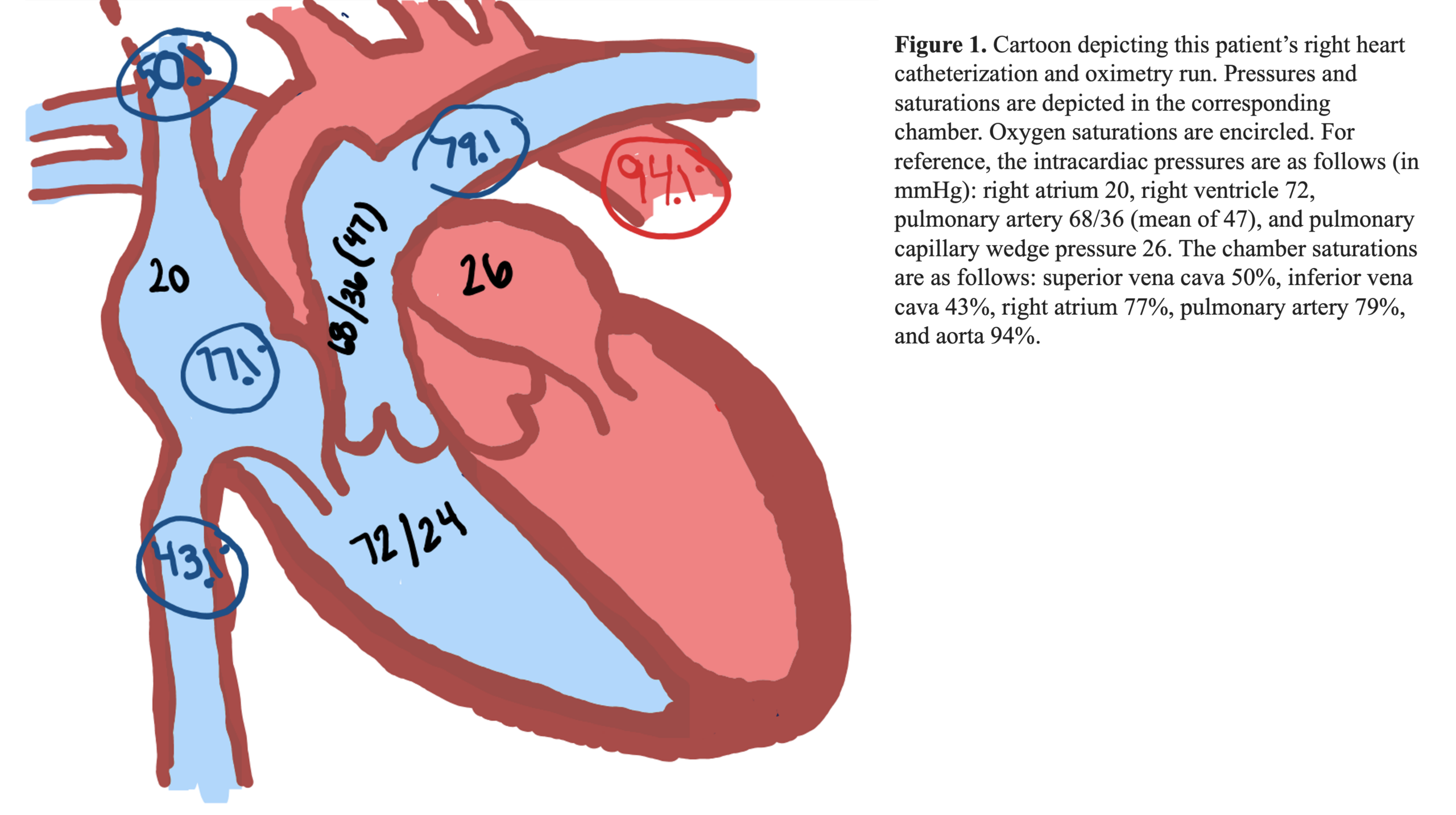 Sinus Venosus Defect With Partial Anomalous Pulmonary - vrogue.co Sinus Venosus Defect With Partial Anomalous Pulmonary - vrogue.co