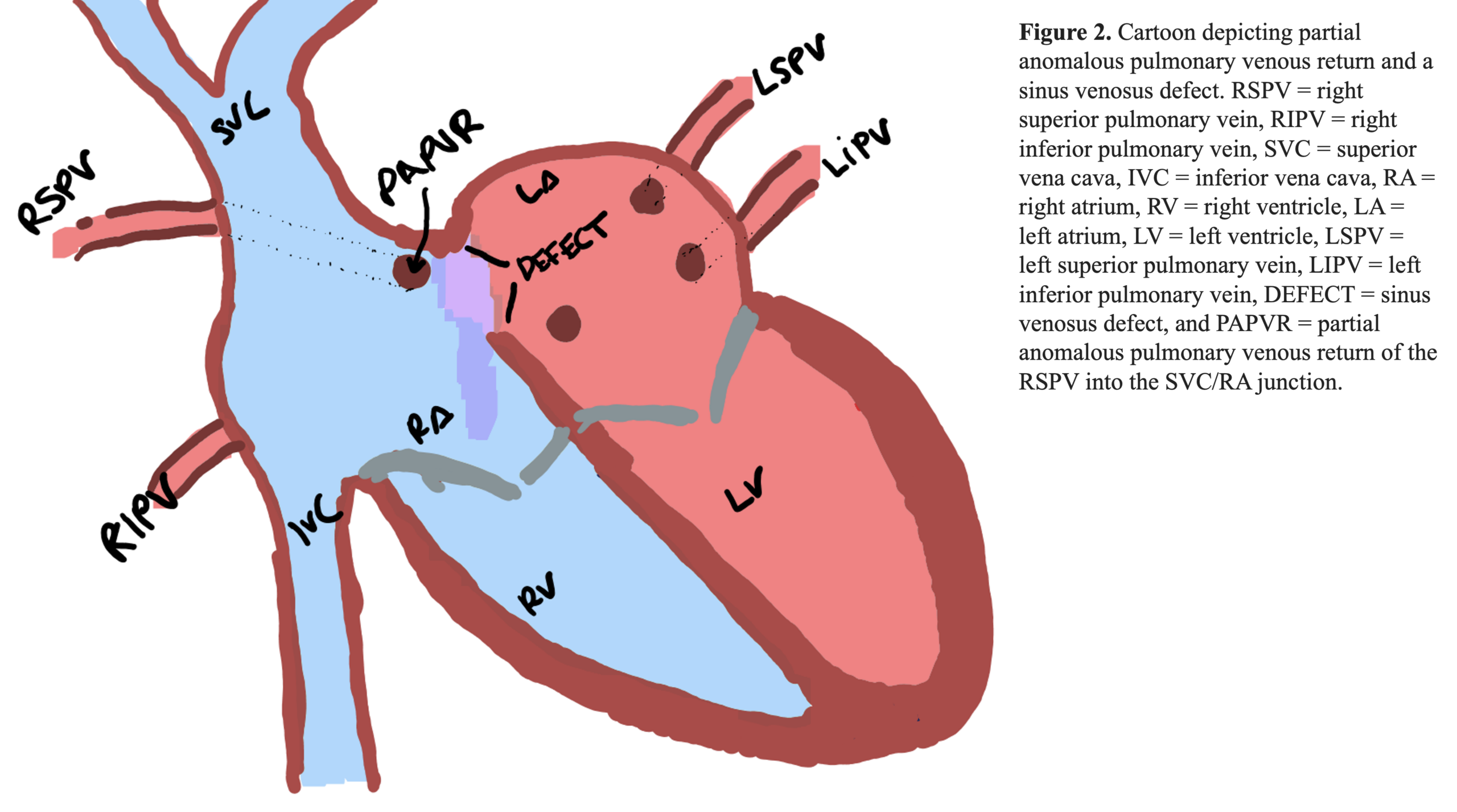 Partial Anomalous Pulmonary Venous Return Pediatric R - vrogue.co Partial Anomalous Pulmonary Venous Return Pediatric R - vrogue.co